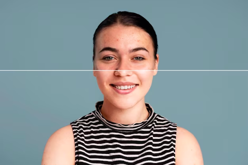 Understanding & Managing Post Inflammatory Hyperpigmentation (PIH)